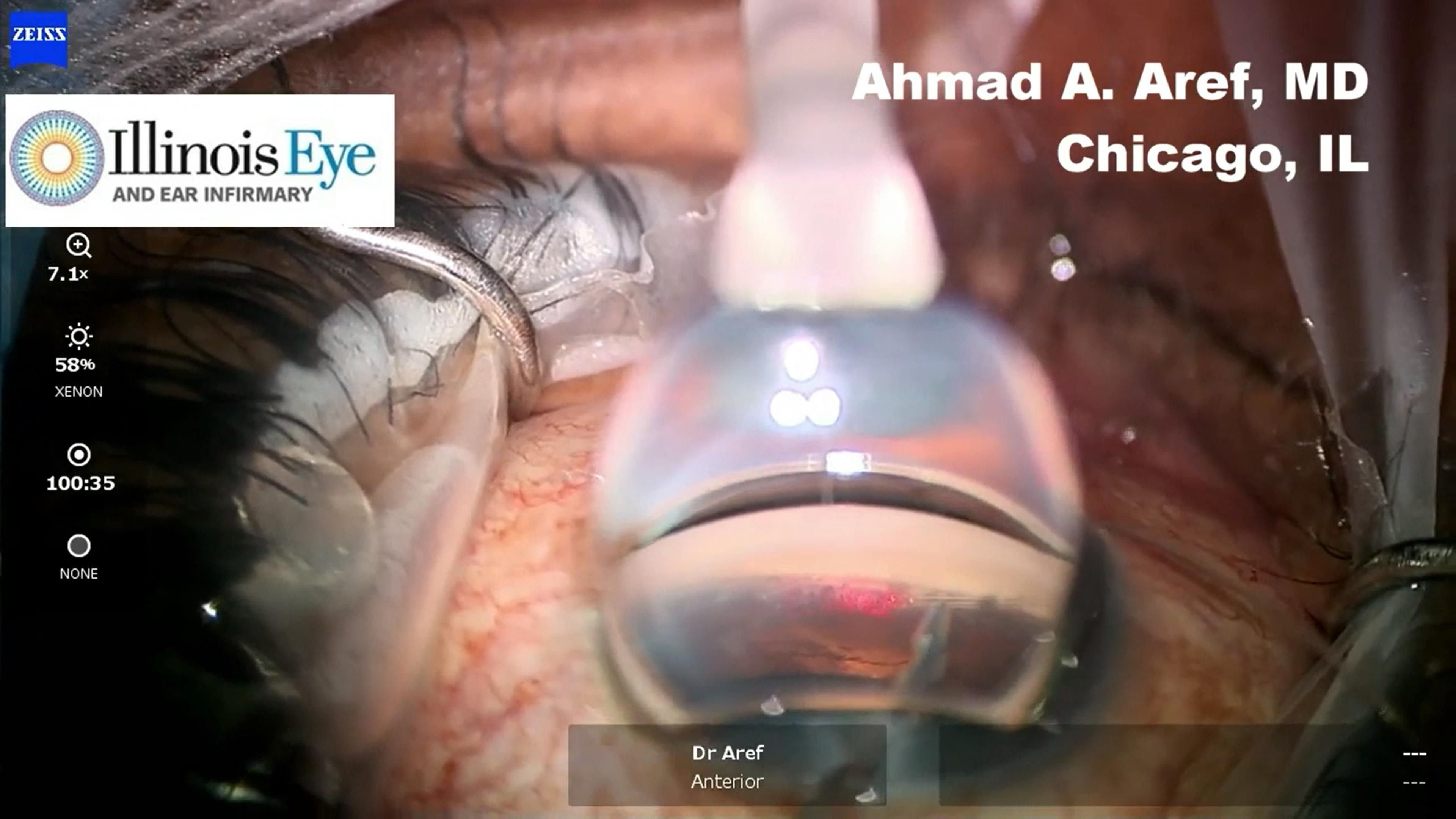 GonioReady Visualization of iTrack ABIC and GATT - Eyetube